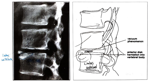 [X-ray reading] L-spine vacuum phenomenon, osteoporosis, bamboo spine ...