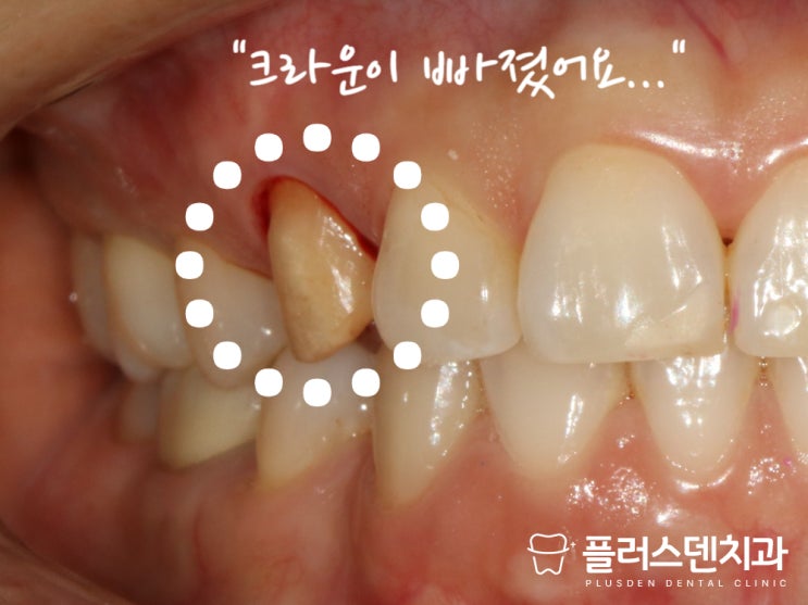 앞니 치아 크라운 빠짐 프렙prep 과정까지 꼼꼼한 플러스덴 치과로 오셔서 교체 치료 받으셔요 크라운 뜻 가격 및