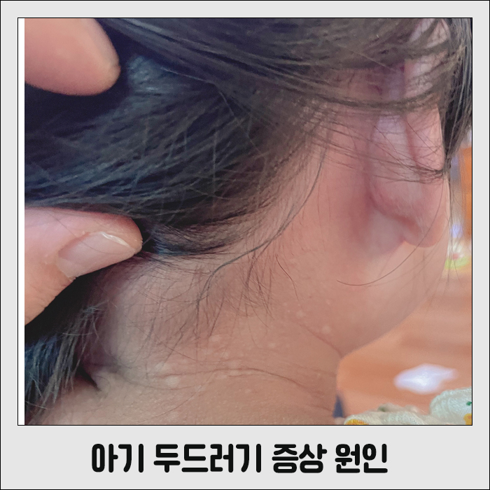 아기 두드러기 증상 원인 유아 몸 배 두드러기 대처 네이버 블로그