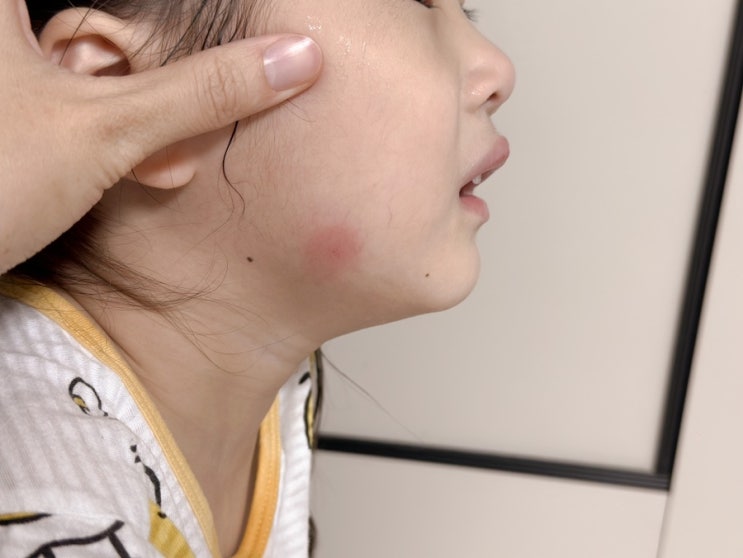 아기 모기약 연고 유아 아기 벌레 모기 물렸을때 알레르기 스키터증후군 증상 네이버 블로그