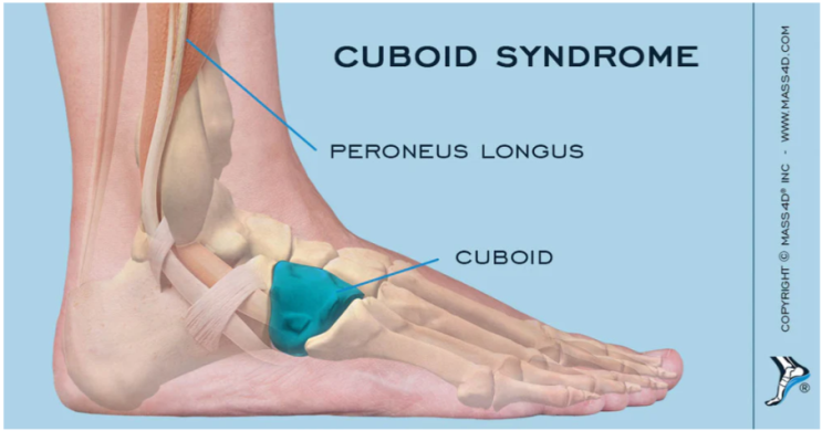 입방골 증후군(Cuboid syndrome) : 네이버 블로그