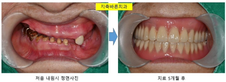 틀니사례 전악 발치 후 상하악 총의치 지축바른치과 지축치과 지축역치과 삼송치과 원흥치과 원당치과 연신내치과 구파발치과 네이버 블로그
