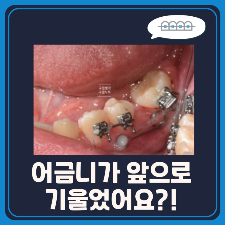 [치아교정]쓰러진 대구치, Molar uprighting, Helical uprighting spring : 네이버 블로그
