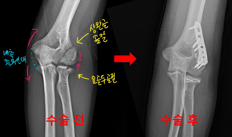 심한 팔꿈치골절 단 한개의 절개로 동시에 2개의 뼈를 고정한 경우 원위상완골과 요골두의 동시골절 네이버 블로그