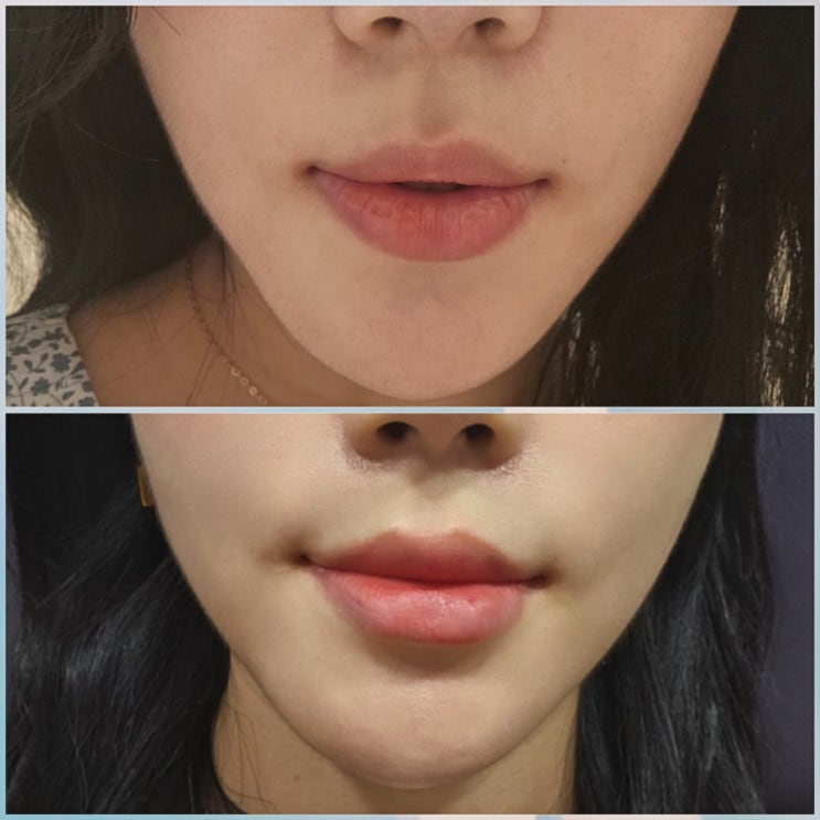 수원필러 광교에서 입술필러입꼬리 보톡스 1cc 받고온 대만족 후기 내돈내산로리앙입술필러 전후통증멍 네이버 블로그