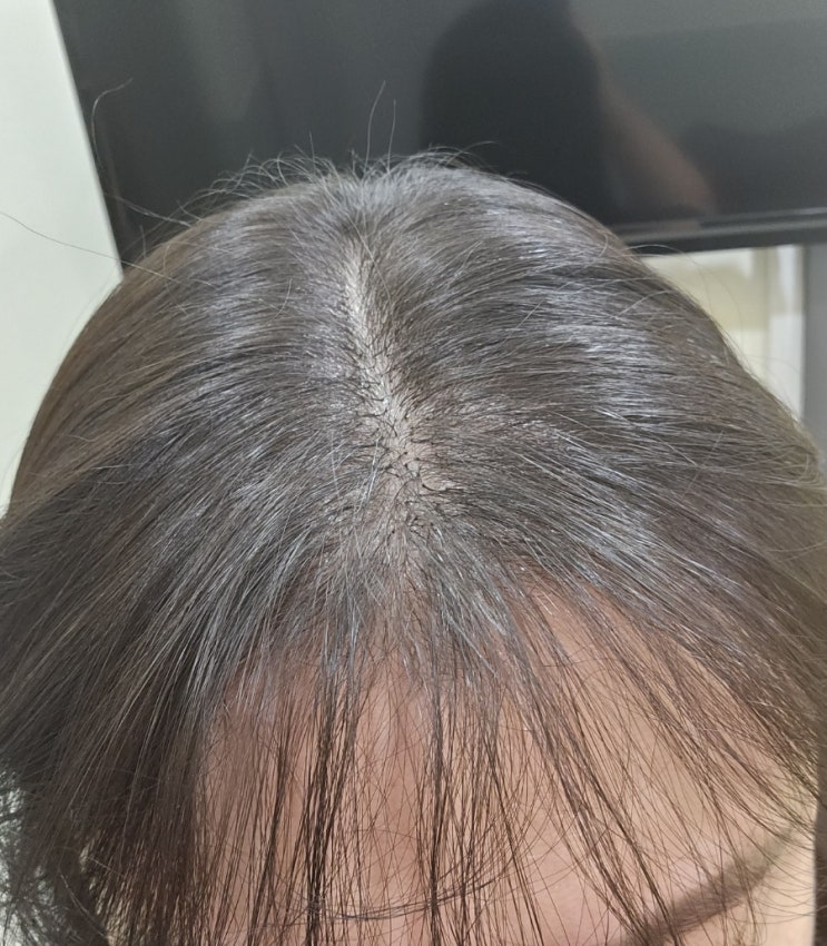 항암가발 헤어증모술 스트레스 그만 마이크로헤어에서 해결 네이버 블로그
