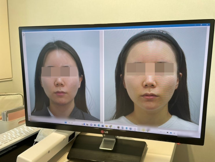 청담 앞 피부과 테일러드 티타늄 리프팅 잘하는 곳 추천 후기 통증 효과 네이버 블로그