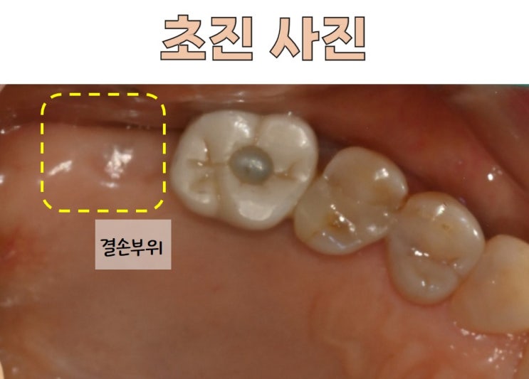 철산 치과 어금니 상실 후 뼈이식 임플란트 수술 받아 잘 해결되었던 소개글 네이버 블로그