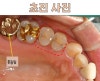 광명치과 어금니 뿌리 염증 있어서 흔들림 발치후 뼈이식 임플란트 수술 진행되었던 증례 네이버 블로그
