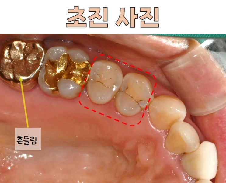 광명치과 어금니 뿌리 염증 있어서 흔들림 발치후 뼈이식 임플란트 수술 진행되었던 증례 네이버 블로그