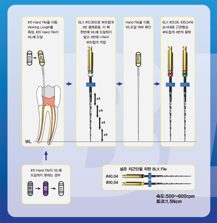 NiTi File/엔진파일 신경(파일)/근관(G.P/P.P)/MTA등 : 네이버 블로그