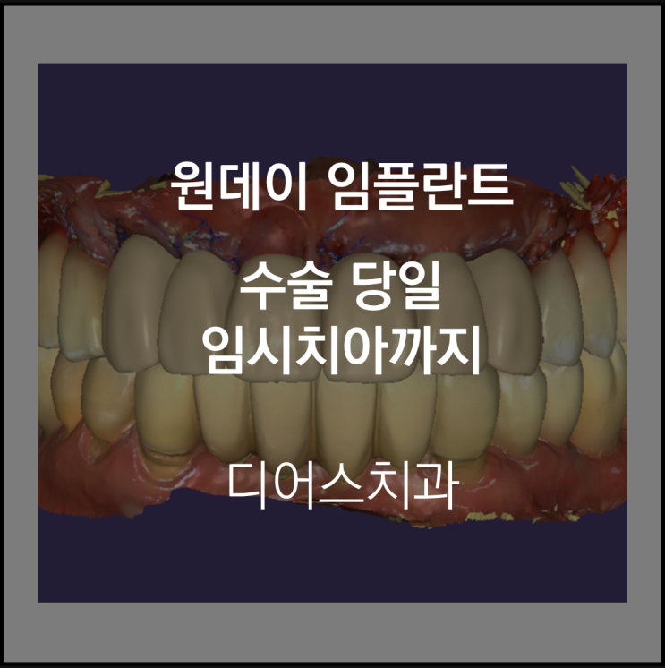 발치와 임플란트 수술과 임시치아를 하루에 강동구 원데이 임플란트 네이버 블로그