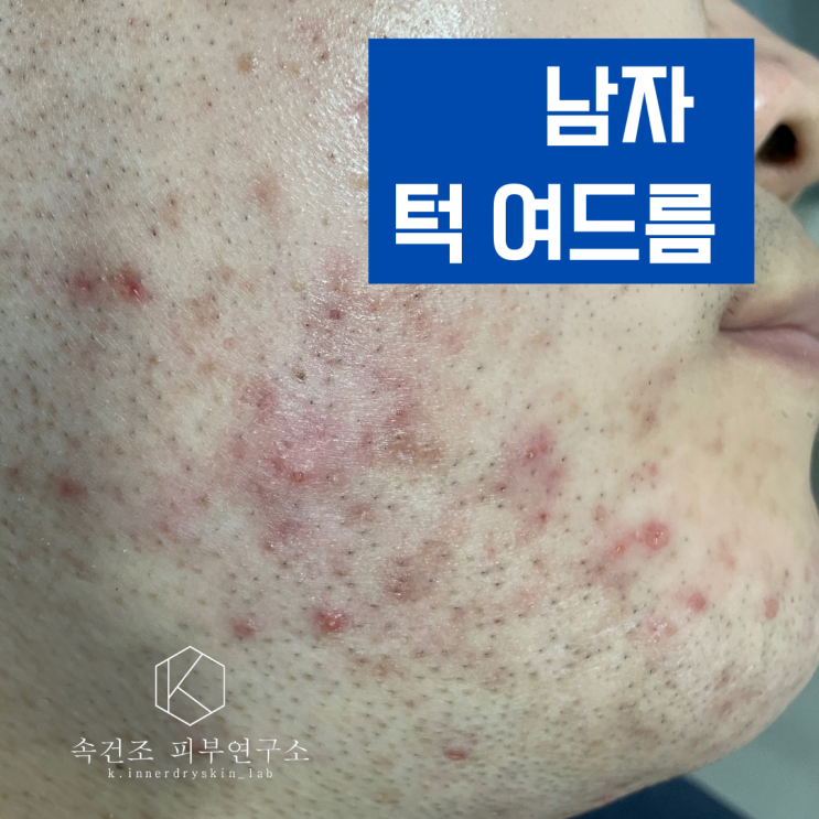 남자 턱 여드름 턱수염 트러블 원인 트러블 흉터관리 네이버 블로그