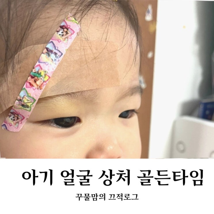 아기 얼굴 상처 골든타임 언제 흉터연고로 관리해요 네이버 블로그