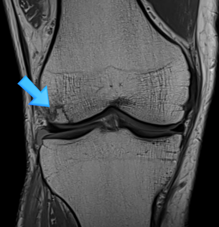 무릎의 자발성 골괴사 (SONK), 혹은 연골하 부전골절(SIFK): 비수술적 치료 결과 : 네이버 블로그