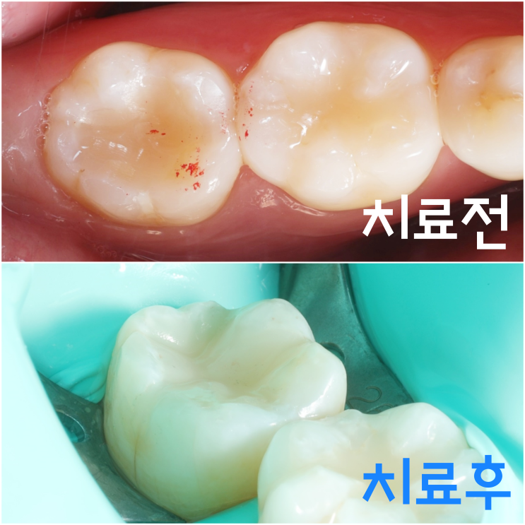 미국에서 레진치료 받았는데 씹을 때 아파요 재치료한 증례 네이버 블로그