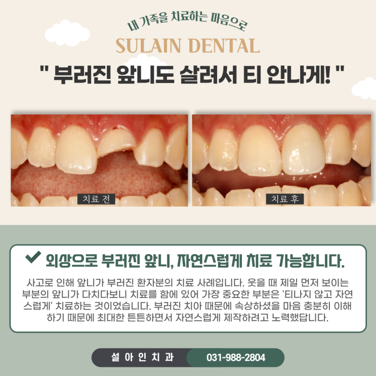 김포앞니 앞니가 부러졌어요 부러진 앞니도 살려서 티 안나게 치료 받으세요 설아인치과 앞니 보철치료 네이버 블로그