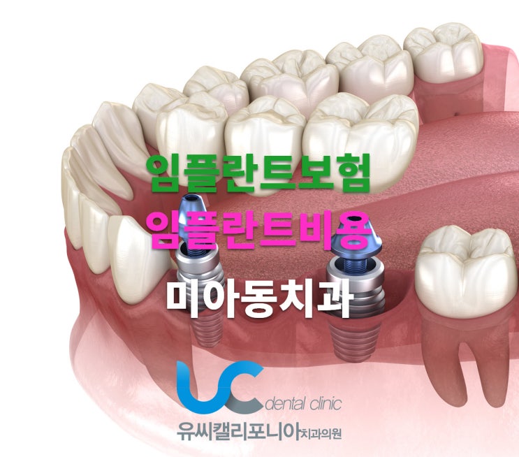 미아동 치과 임플란트 보험 적용 임플란트 비용 얼마? : 네이버 블로그
