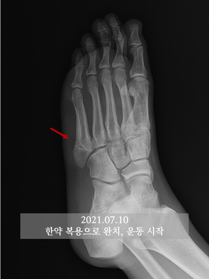 발등 피로골절 활동을 할 때마다 통증이 발생되어 힘들다면 네이버 블로그