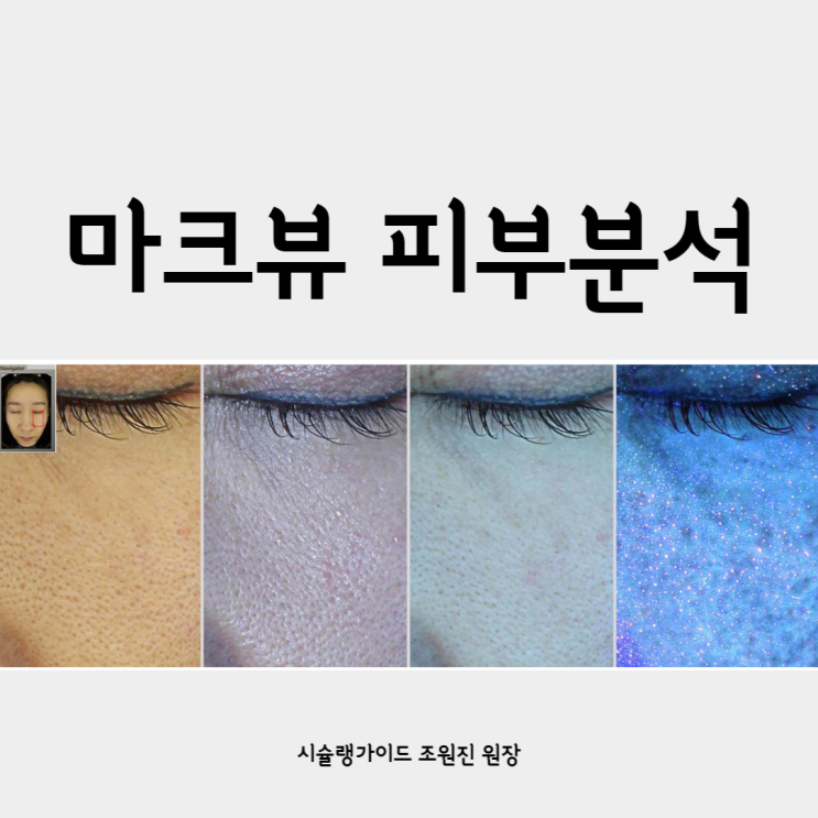 합정 피부과 마크뷰(Mark-Vu)를 이용한 피부진단 : 네이버 블로그