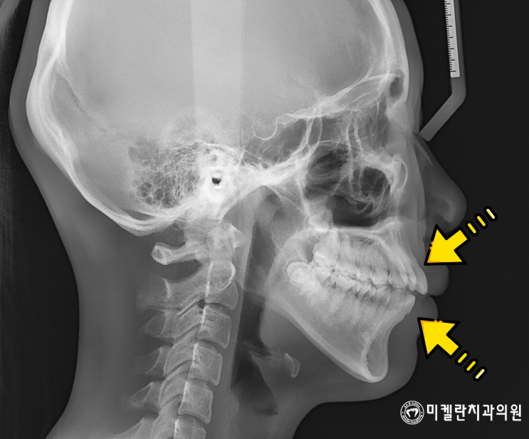 앞니 가 잘 물리지 않아서 식사 어려워요 미켈란 치과 에서 개방교합 개선해드린 임상증례 네이버 블로그