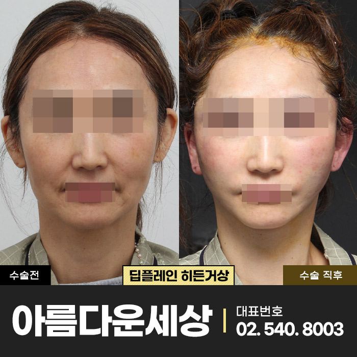 이중턱 없애고 깔끔하고 세련된 턱선을 만들어주는 남자턱선리프팅 여자턱선리프팅 신사역리프팅 네이버 블로그