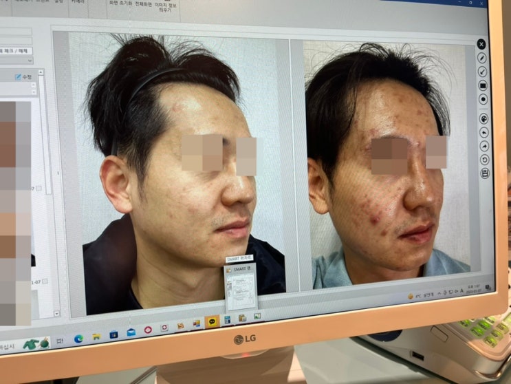 마곡에 위치한 피부과에서 염증성 여드름 치료 후기 : 네이버 블로그