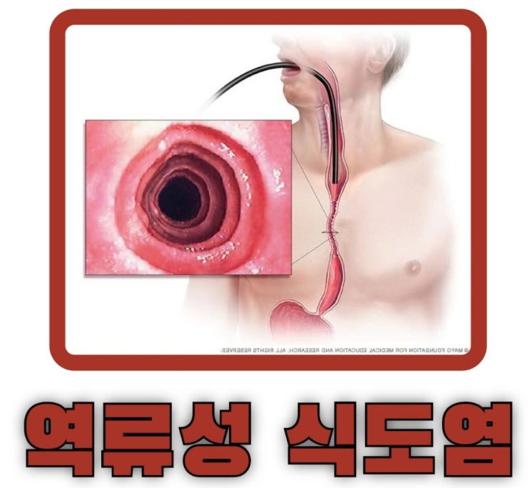 역류성식도염 증상 원인 좋은음식 치료 역류성식도염은 왜 생길까 네이버 블로그