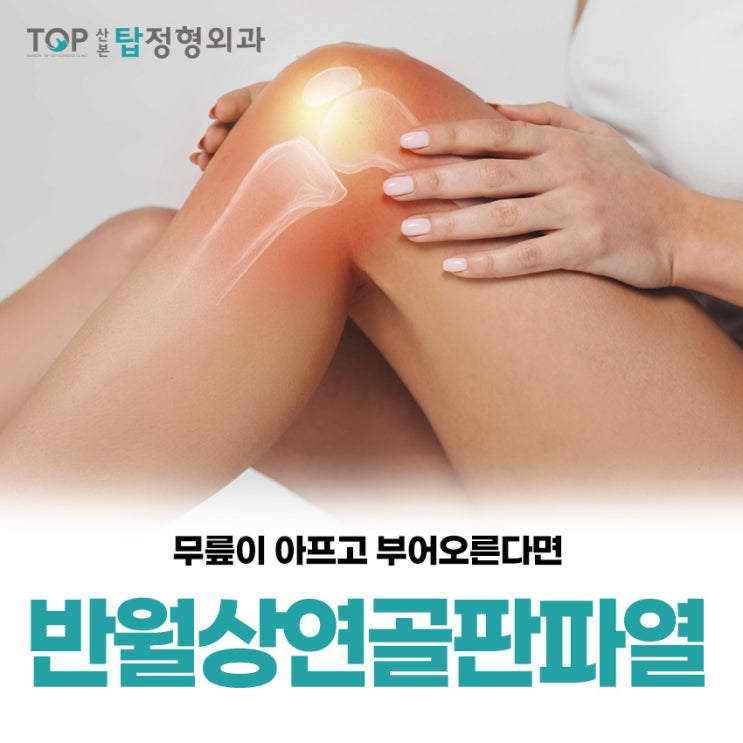 군포동정형외과 무릎이 아프고 부어오른다면 반월상연골판파열 의심 네이버 블로그