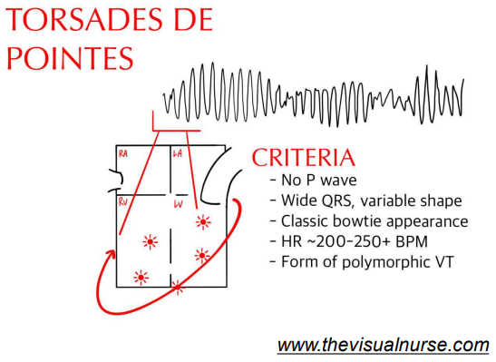 EKG : Ventricular rhythm 기초, TdP(Torsades de pointes) : 네이버 블로그