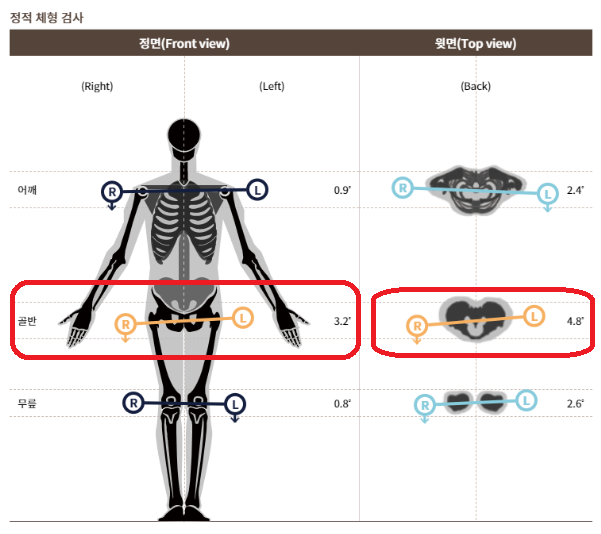 골반교정 방법 틀어진 골반은 척추교정과 동시에 교정해야 합니다 네이버 블로그