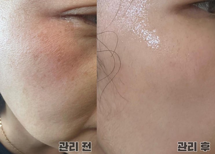 얼굴 피부 열감 안면홍조크림으로 붉은기 원인 잡았어요 네이버 블로그