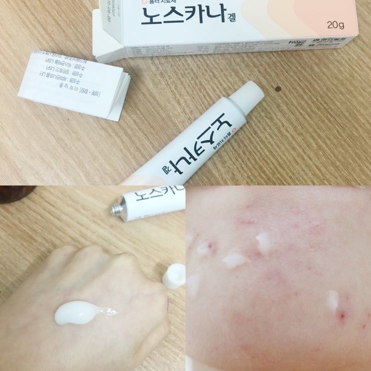 노스카나 연고 효과 여드름 색소침착 흉터에 사용법 네이버 블로그