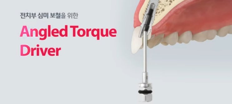 [해결완료 임플란트과] 전치부 보철을 위한osstem angled torque driver (앵글드 토크 드라이버) 괜찮은가요 ...