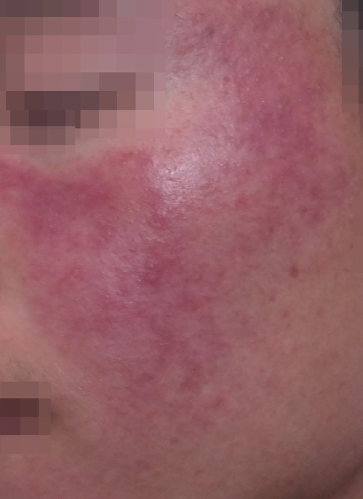 제주도한방피부과 얼굴 지루성피부염의 치료과정 사진으로 살펴보기스테로이드 리바운드 네이버 블로그