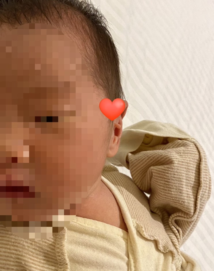 돌아기 스킨텍 제거 수술 일산 동국대병원 타이 시술and이뽀라 성형외과 첫방문 상담 네이버 블로그