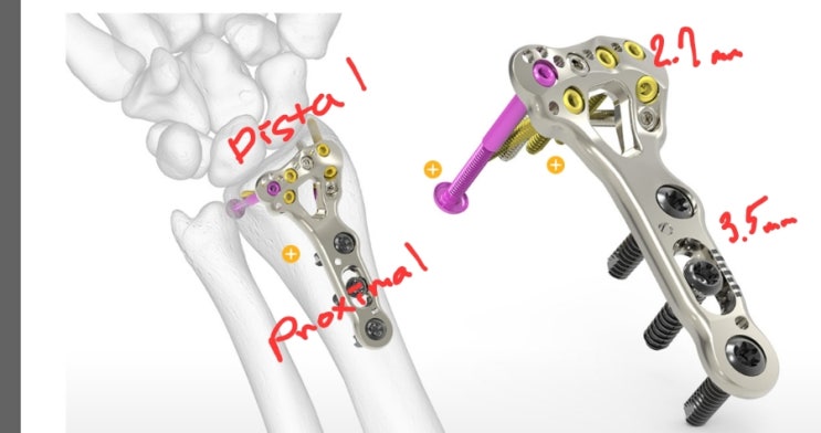 수술실 정형외과스크럽- wrist plate ORIF(VA-LCP) : 네이버 블로그