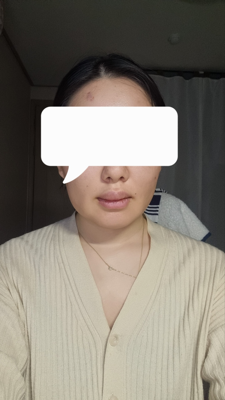 100 개인후기 양악 And 윤곽 후기 24 5일차 두통 입술찢어지는고통 네이버 블로그