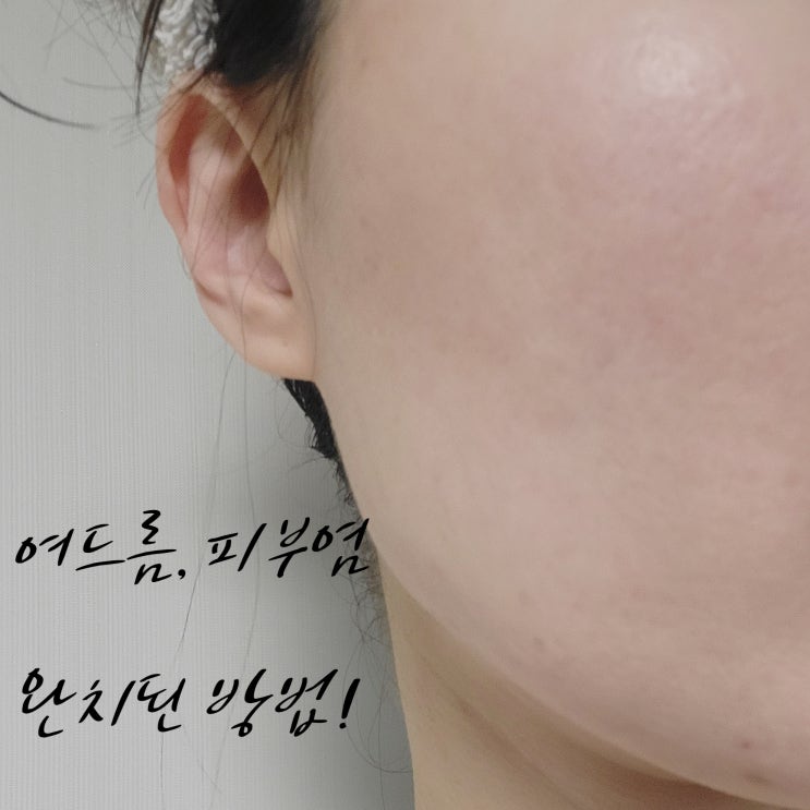주사 피부염 접촉성 여드름 완치 방법 간단해요 네이버 블로그