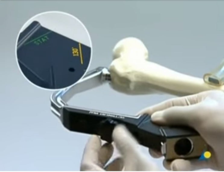 수술실 정형외과스크럽 Femur fx(PFNA-3) blade insertion- PFNA procedure : 네이버 블로그