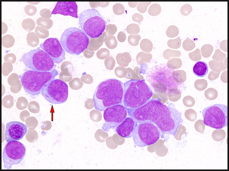 급성골수성백혈병(AML), WHO 분류 체계(제5판) : 네이버 블로그
