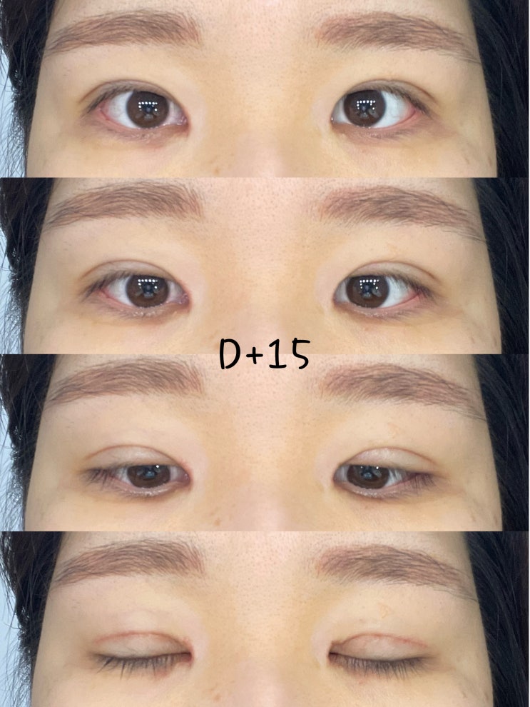 절개쌍수 눈매교정 재수술 후기3 쌍수 7일~2주차 경과 사진 네이버 블로그