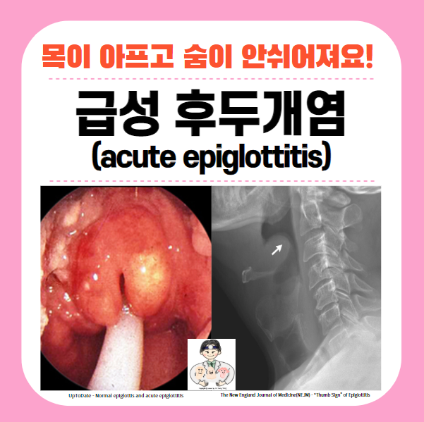 급성 후두개염(acute epiglottitis) - 목이 아프고 숨이 안쉬어져요! : 네이버 블로그