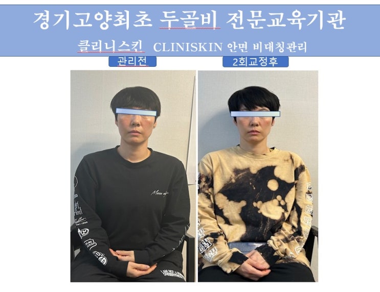 2023학년도 고양외국어고등학교 합격을 축하합니다~ 얼굴비대칭교정전문교육기관 고양관산외고5분거리 클리니스킨 네이버 블로그