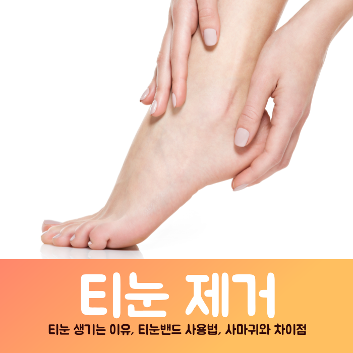 티눈 생기는 이유 신신 티눈밴드 사용법 제거 방법 발가락 발바닥 사마귀 차이 네이버 블로그