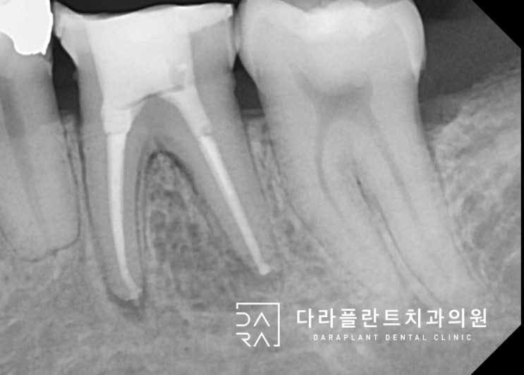 치아 신경치료에 대한 생각차이 덕양구 신경치료치과 네이버 블로그