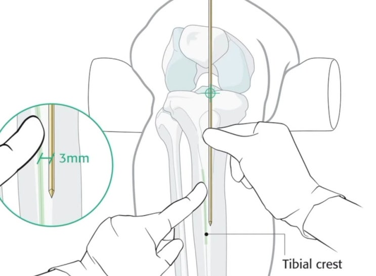 정형외과 스크럽 -Tibia nail (ETN) procedure- Tibia nailing CR/IF(Tibia shaft ...