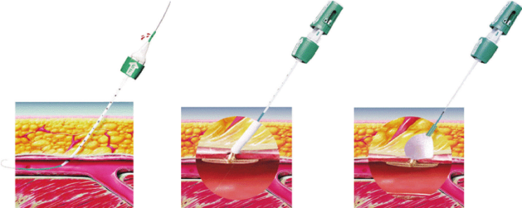 인터벤션 대퇴동맥 지혈기구 (Closure devices) : 네이버 블로그