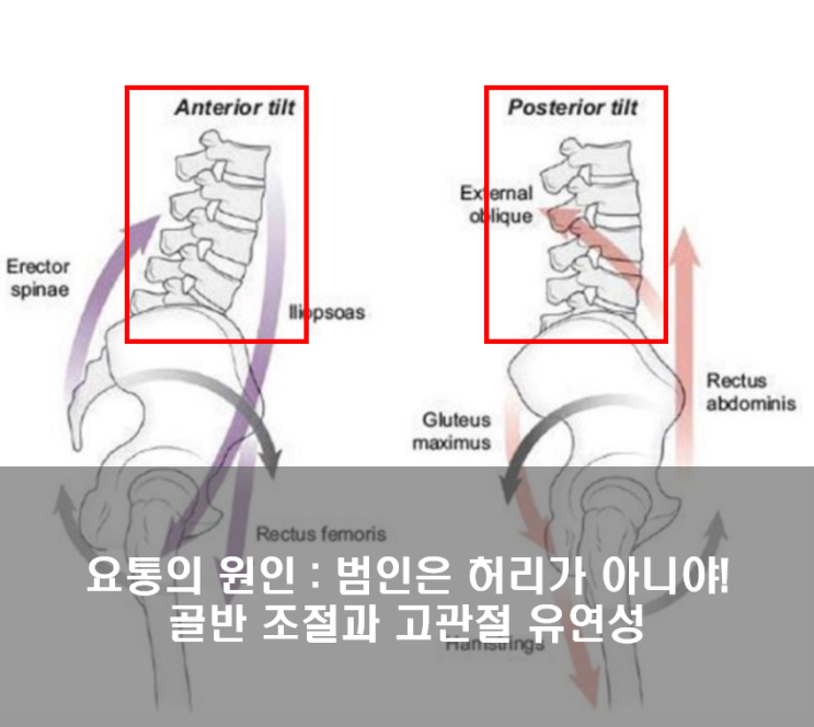 요통의 기능적 평가 Pelvic control : 그 첫번째 이야기 : 네이버 블로그