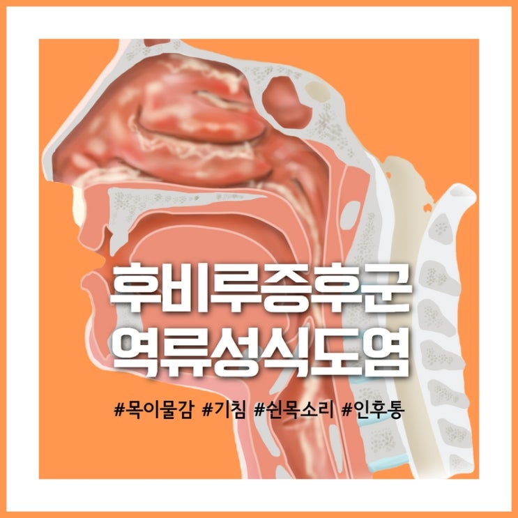 비염 없는 후비루증후군 코가 뒤로 넘어갈 때 목이물감 만성기침 쉰목소리의 원인 위산역류 네이버 블로그